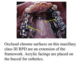 7 tooth selection for partial denture | PPT