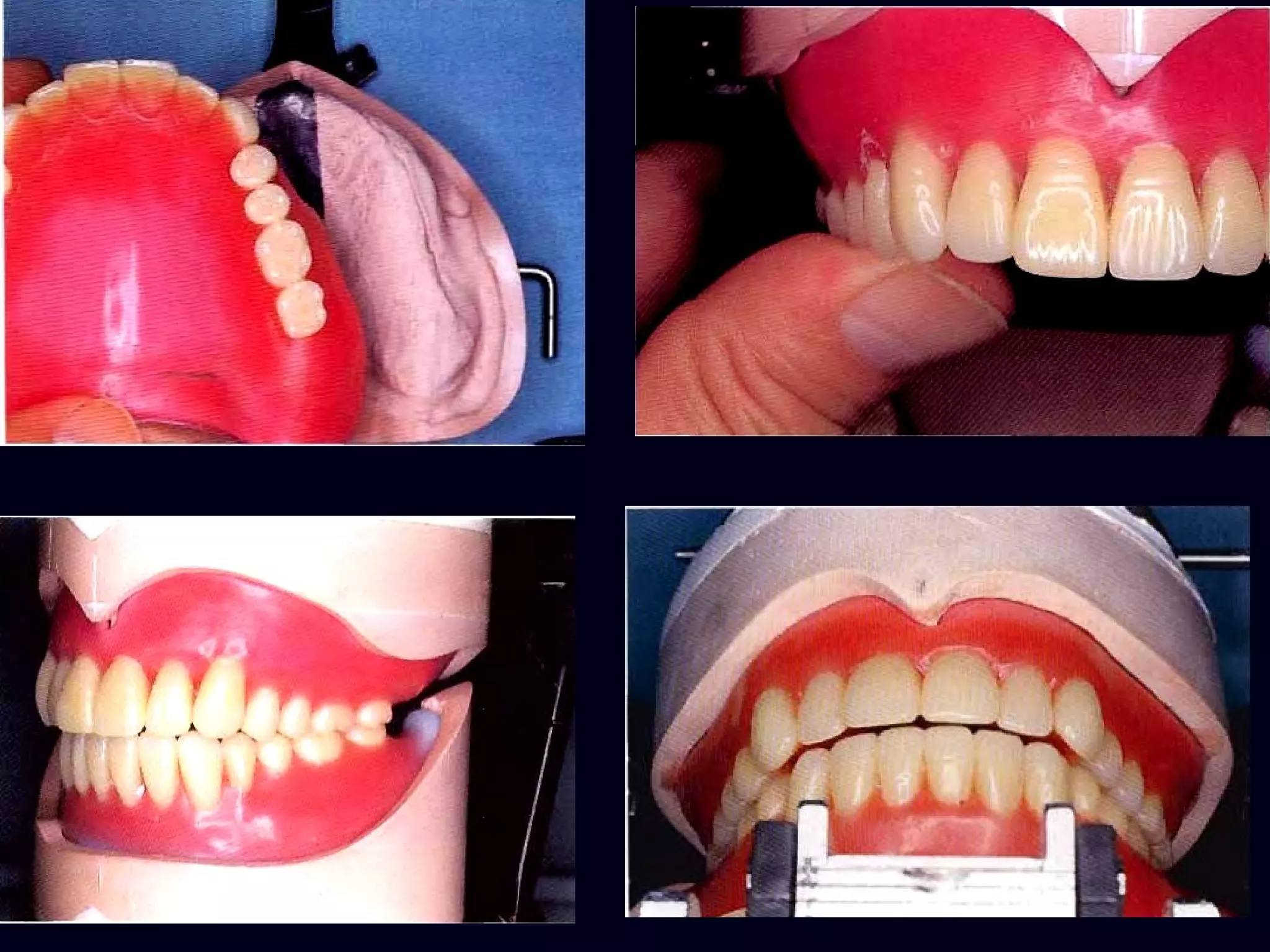 7 try-in of the wax trial complete denture | PPT