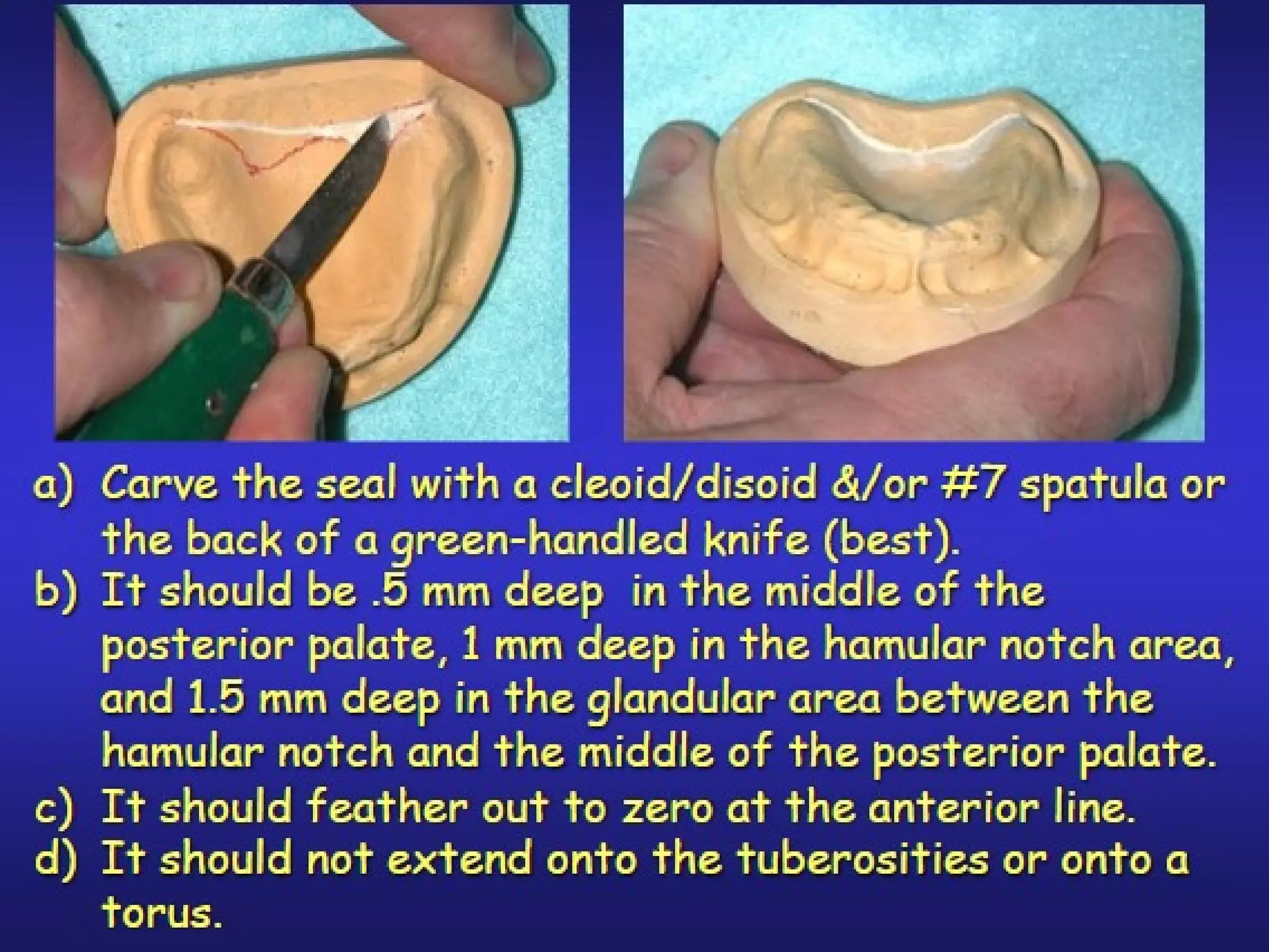 7 try-in of the wax trial complete denture | PPT