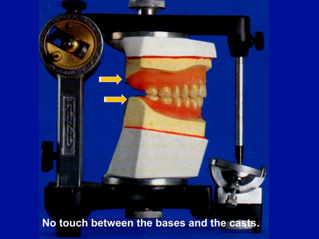 7 try-in of the wax trial complete denture | PPT | Dental Health ...