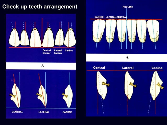 7 try-in of the wax trial complete denture | PPT | Dental Health ...