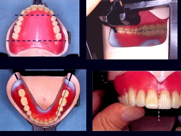 7 try-in of the wax trial complete denture | PPT | Dental Health ...