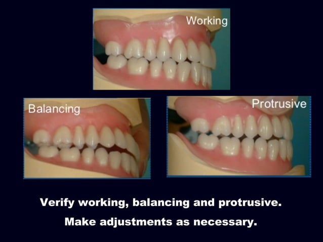 7 try-in of the wax trial complete denture | PPT | Dental Health ...