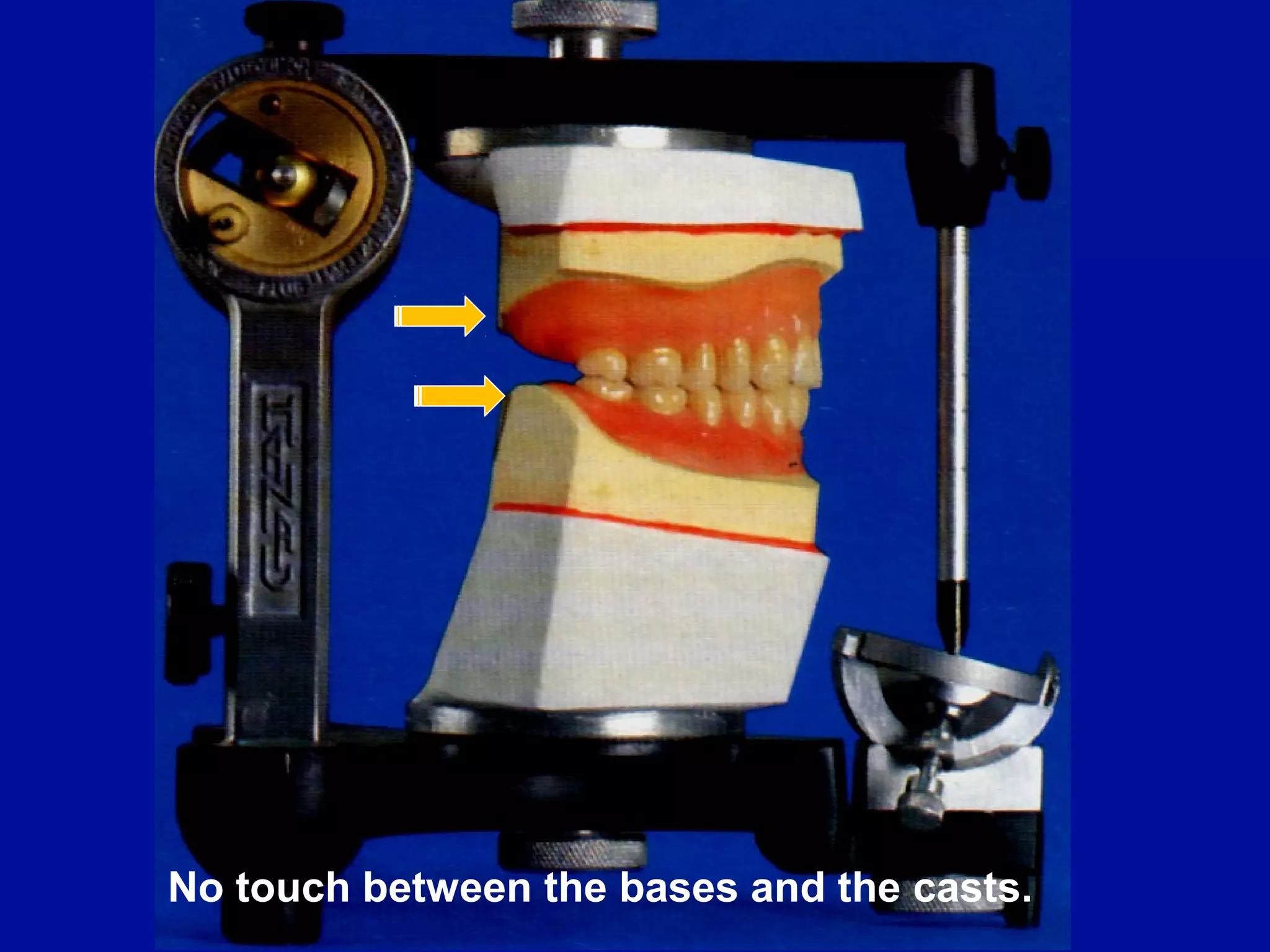 7 try-in of the wax trial complete denture | PPT