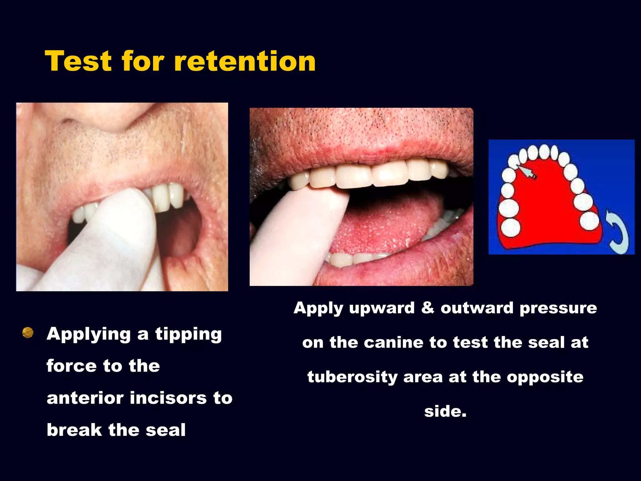 7 try-in of the wax trial complete denture | PPT | Dental Health ...