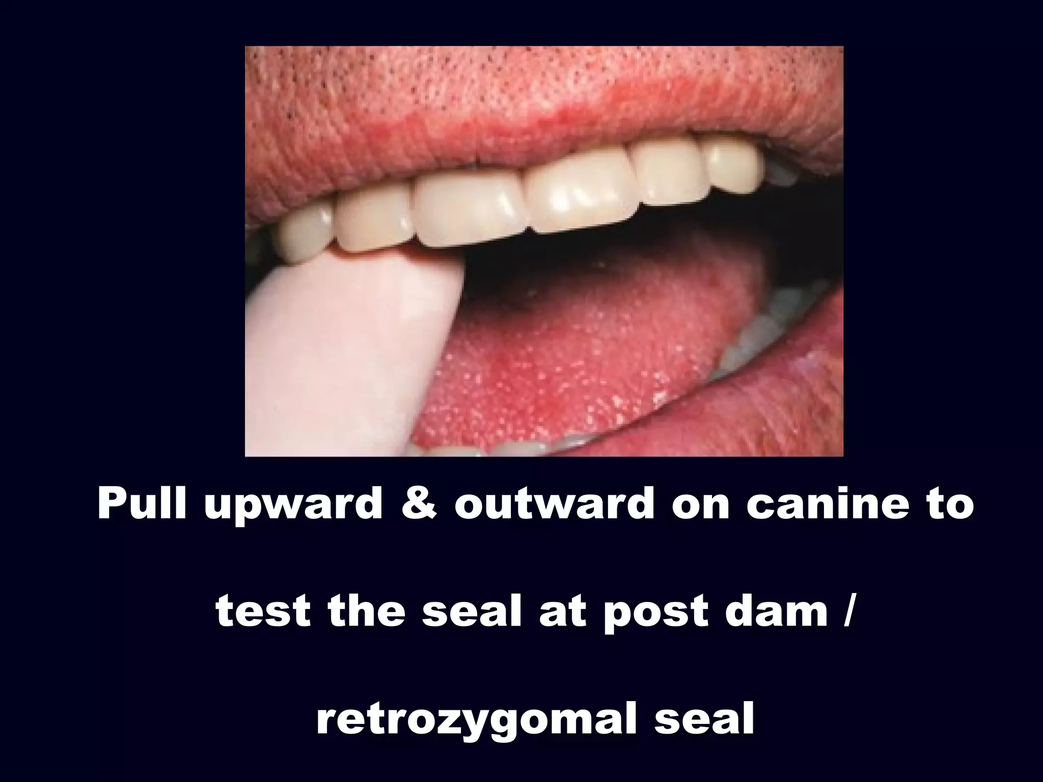 7 try-in of the wax trial complete denture | PPT