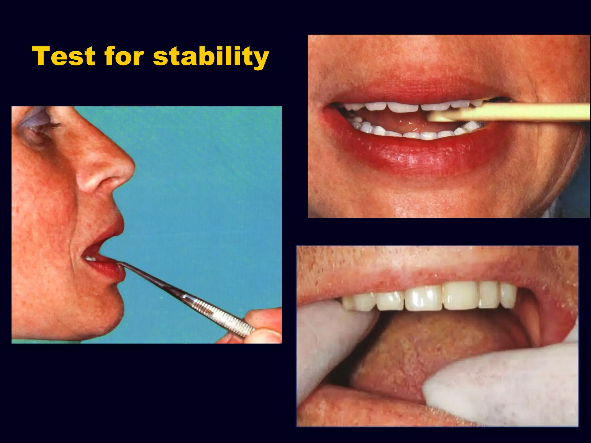 7 try-in of the wax trial complete denture | PPT