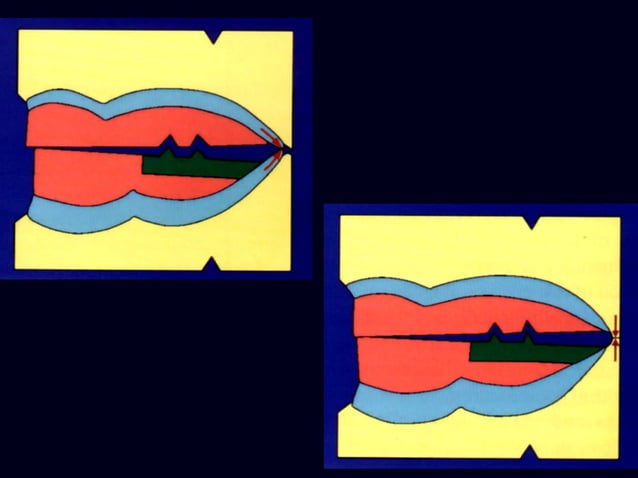 7 try-in of the wax trial complete denture | PPT | Dental Health ...