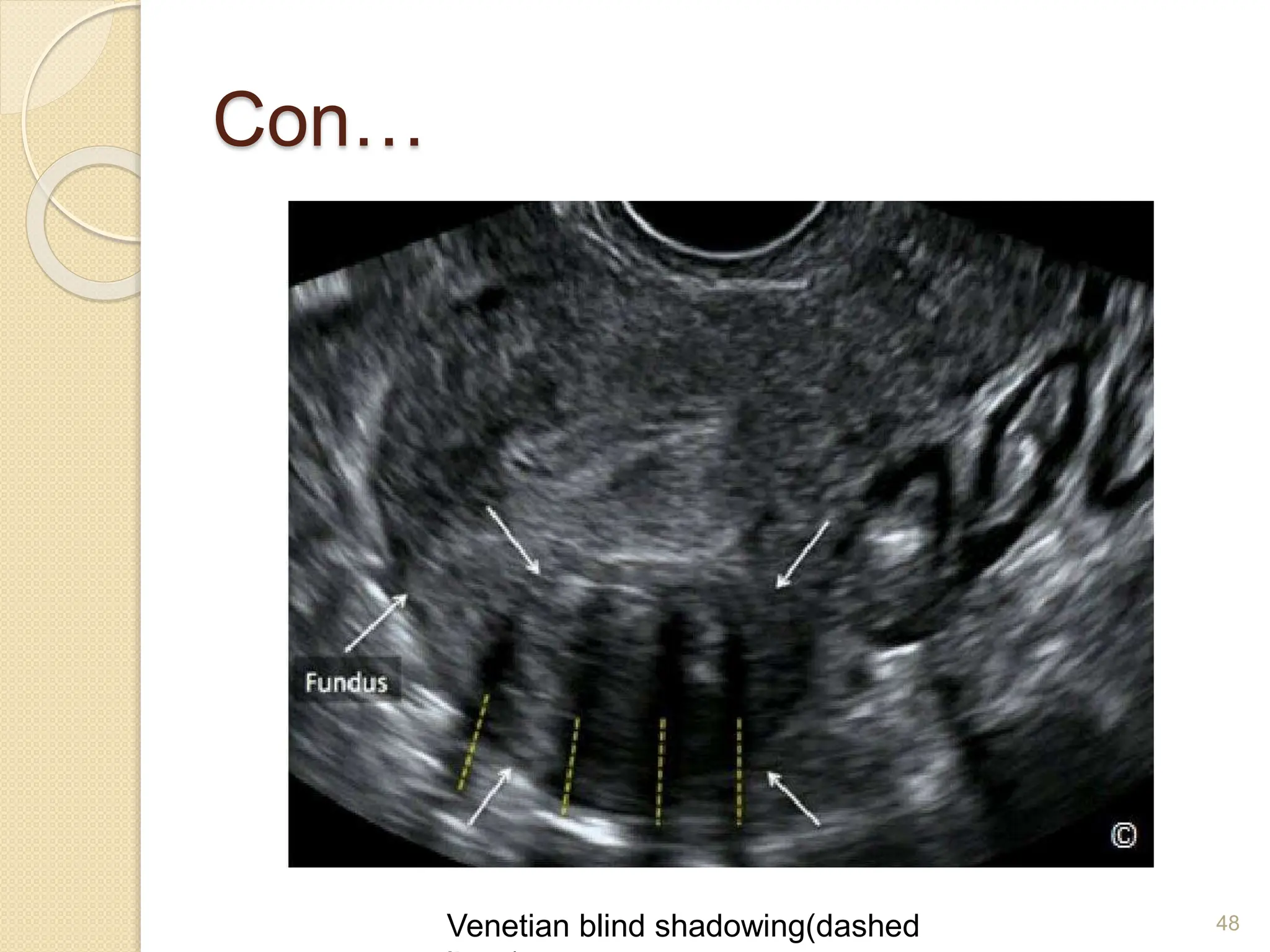 Ultrasound - US of the Non-Pregnant Uterus | PPTX