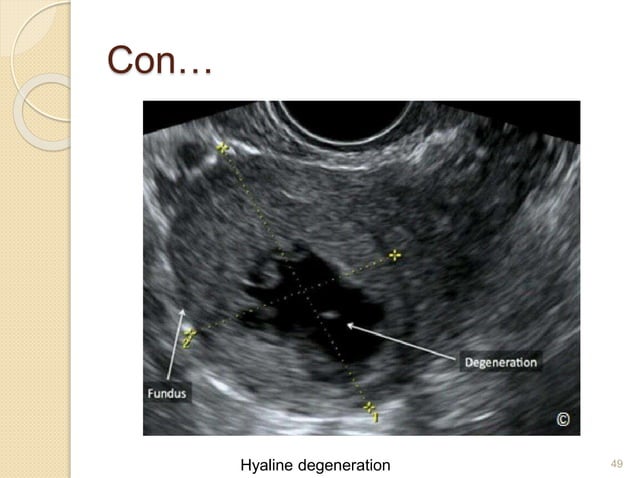 Ultrasound - US of the Non-Pregnant Uterus | PPTX