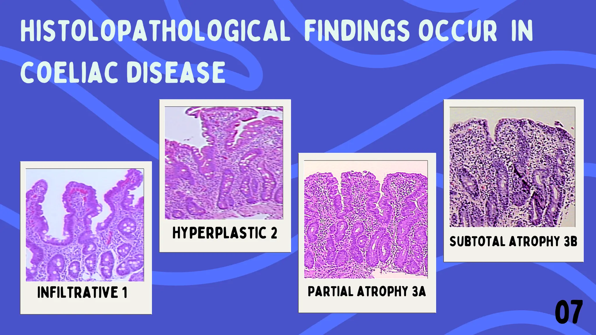 coeliac disease- an autoimmune disease in rise | PDF