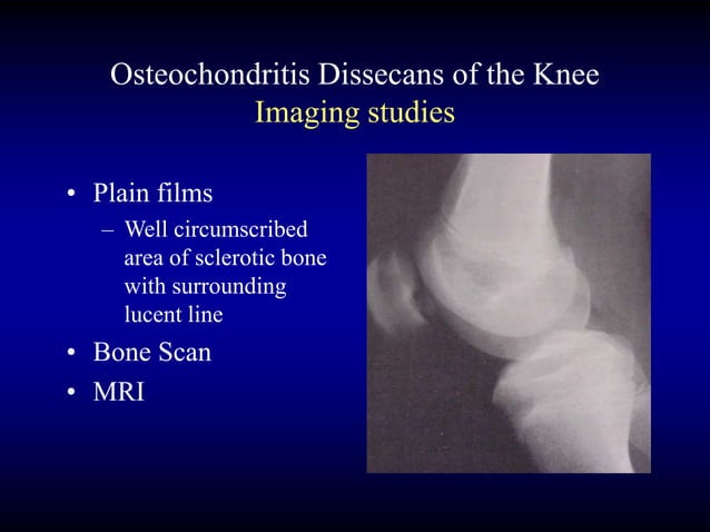 Osteocondritis disecante de rodilla juvenil | PPT | Death, Injury, or ...