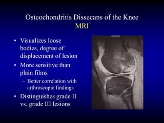 Osteocondritis disecante de rodilla juvenil | PPT