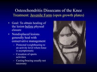 Osteocondritis disecante de rodilla juvenil | PPT