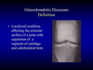 Osteocondritis disecante de rodilla juvenil | PPT