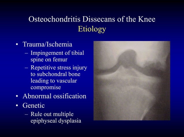 Osteocondritis disecante de rodilla juvenil | PPT | Death, Injury, or ...