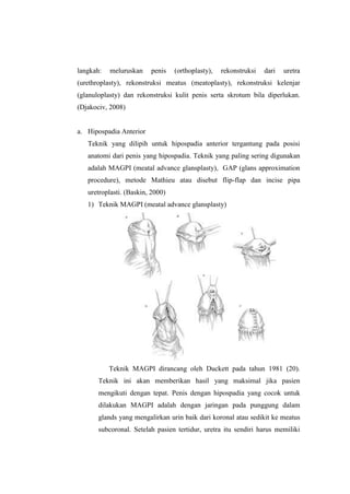 70233922-HIPOSPADIA.doc