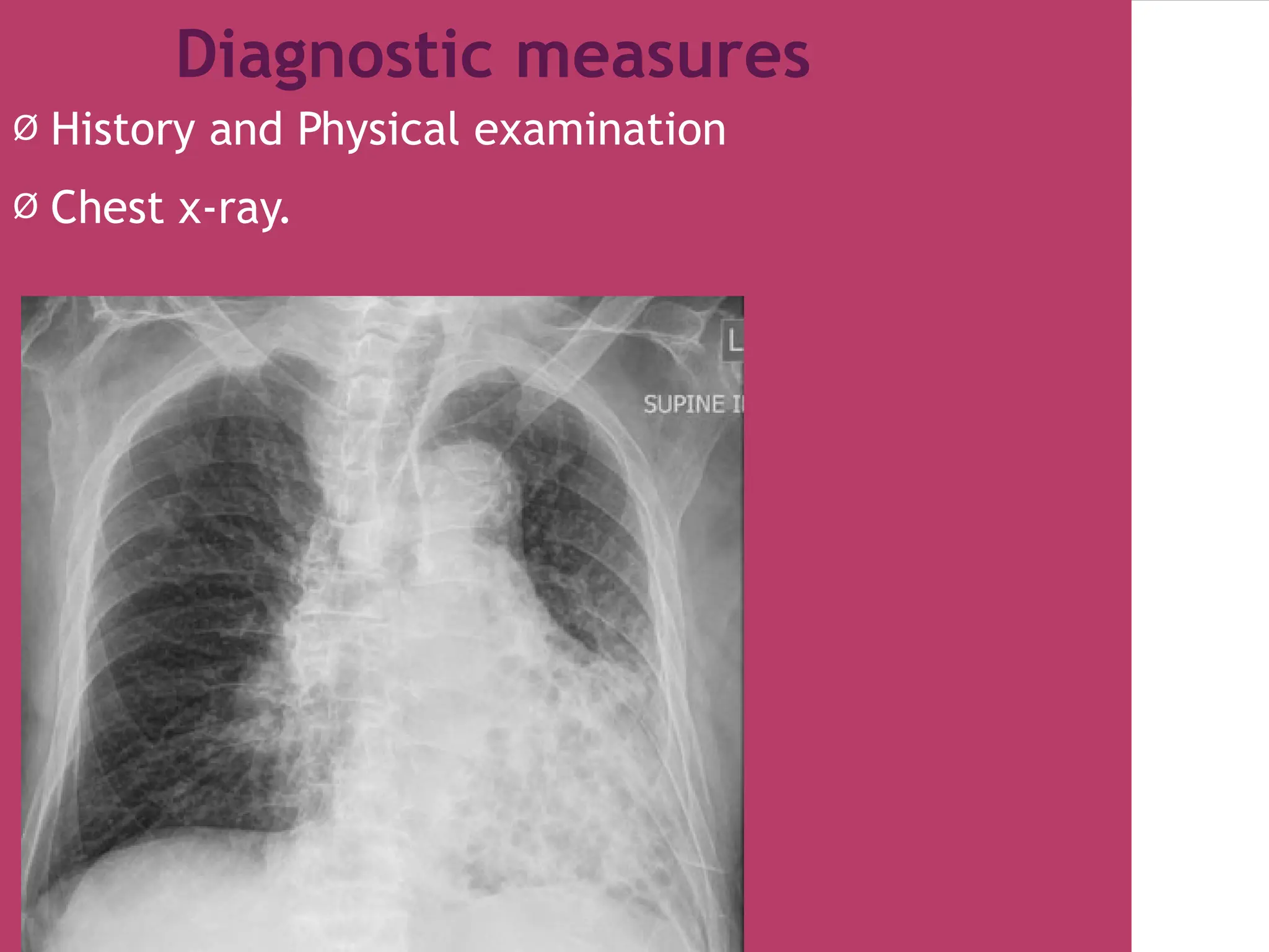 BRONCHIECTASIS and their causes, symptoms | PDF | Lung and Respiratory ...