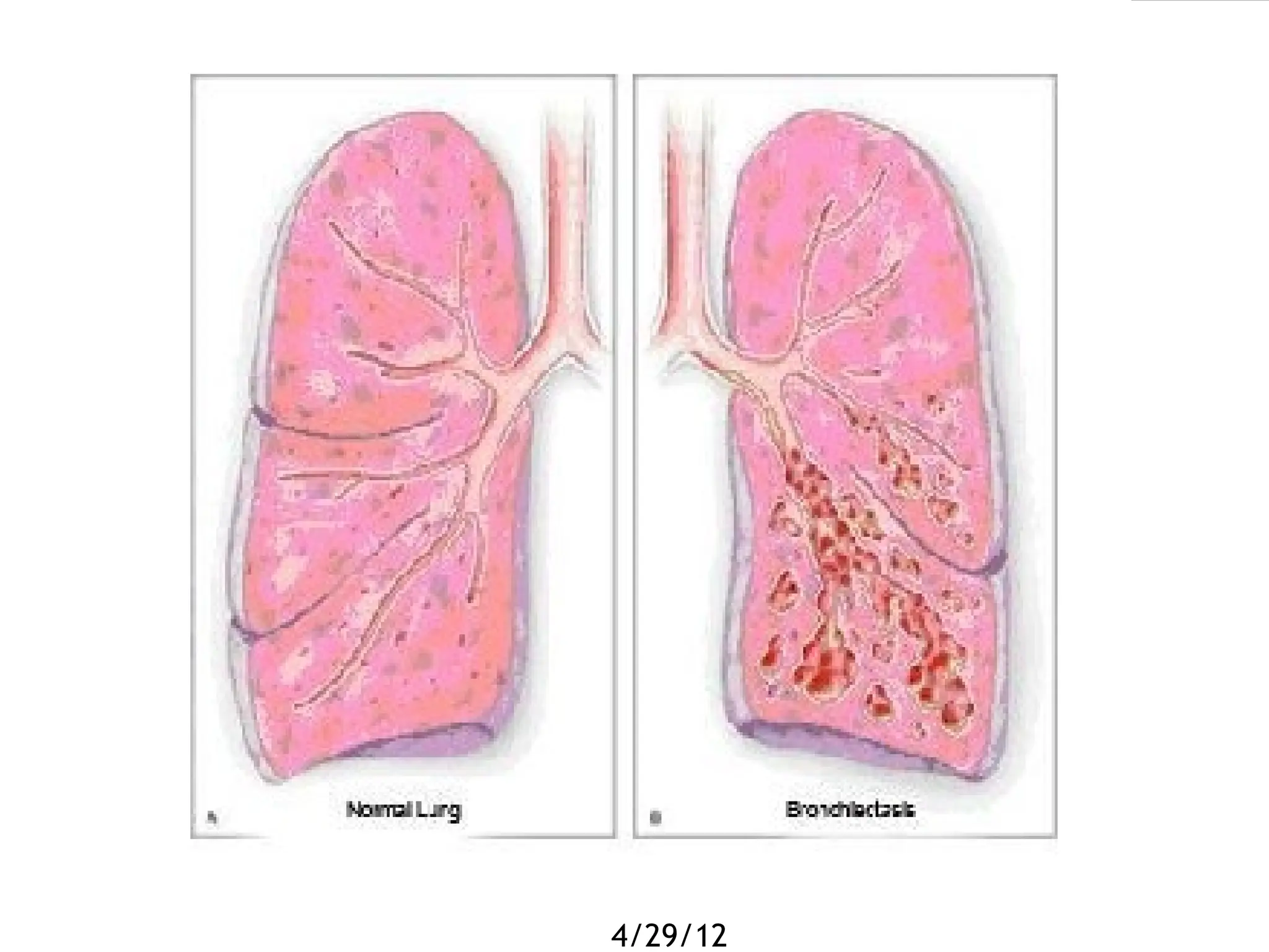 BRONCHIECTASIS and their causes, symptoms | PDF | Lung and Respiratory ...