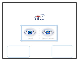 709933087-Cataract-final-lesson-plan.docx