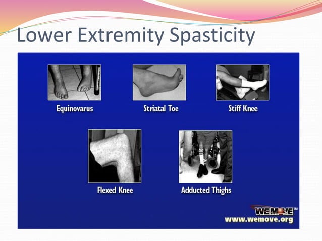 SPASTICITY | PPT
