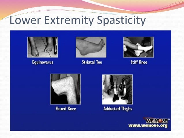 SPASTICITY