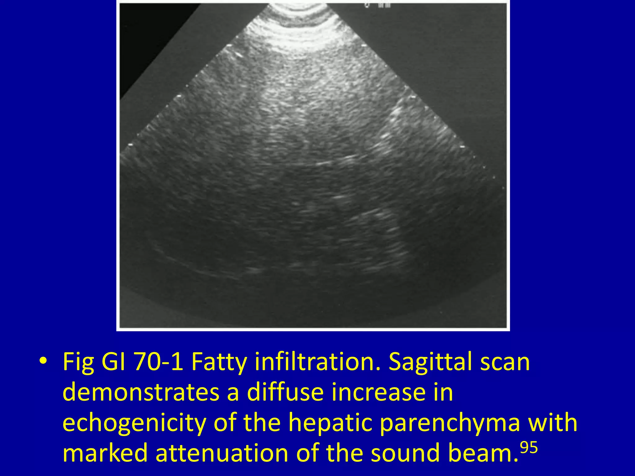 70 generalized increased echogenicity of the liver | PPT