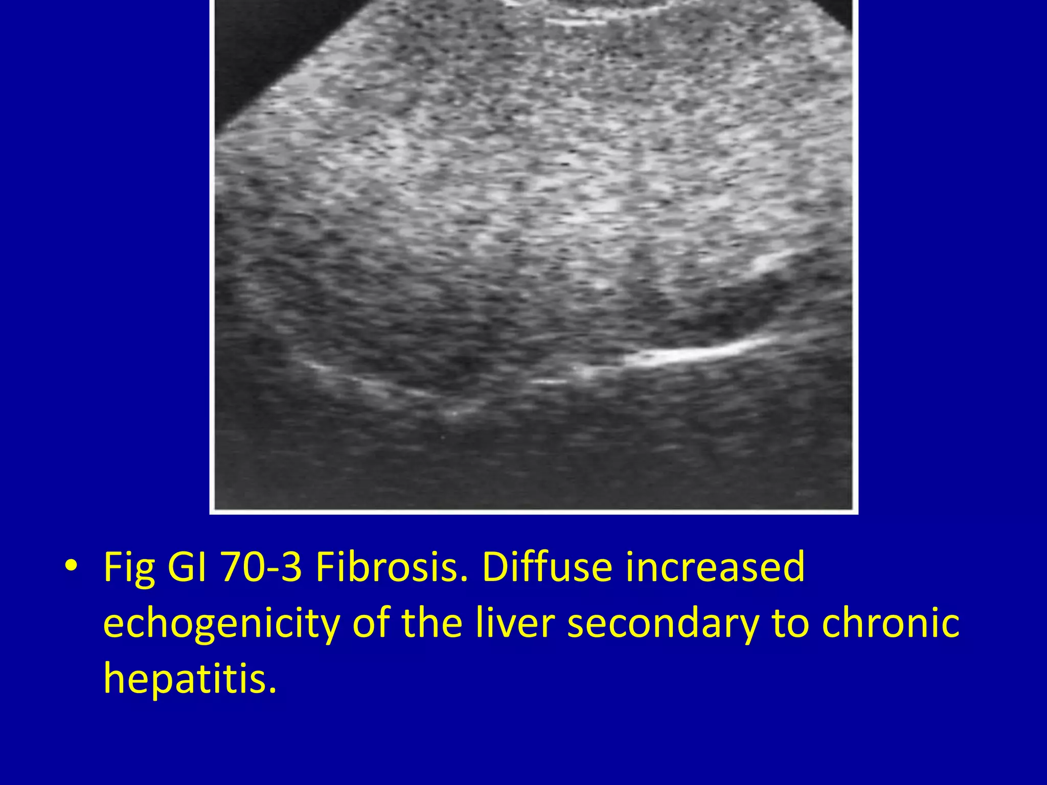 70 generalized increased echogenicity of the liver | PPT