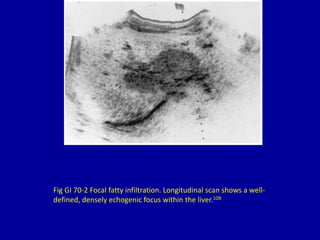70 generalized increased echogenicity of the liver | PPT