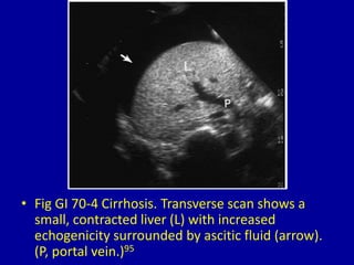 70 generalized increased echogenicity of the liver | PPTX