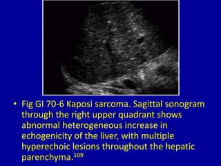 70 generalized increased echogenicity of the liver | PPT