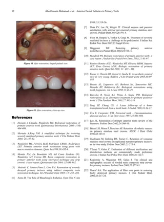 Anterior dental esthetics in primary teeth | PDF