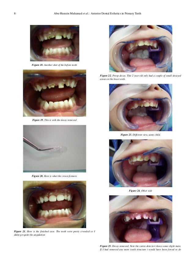 Anterior dental esthetics in primary teeth