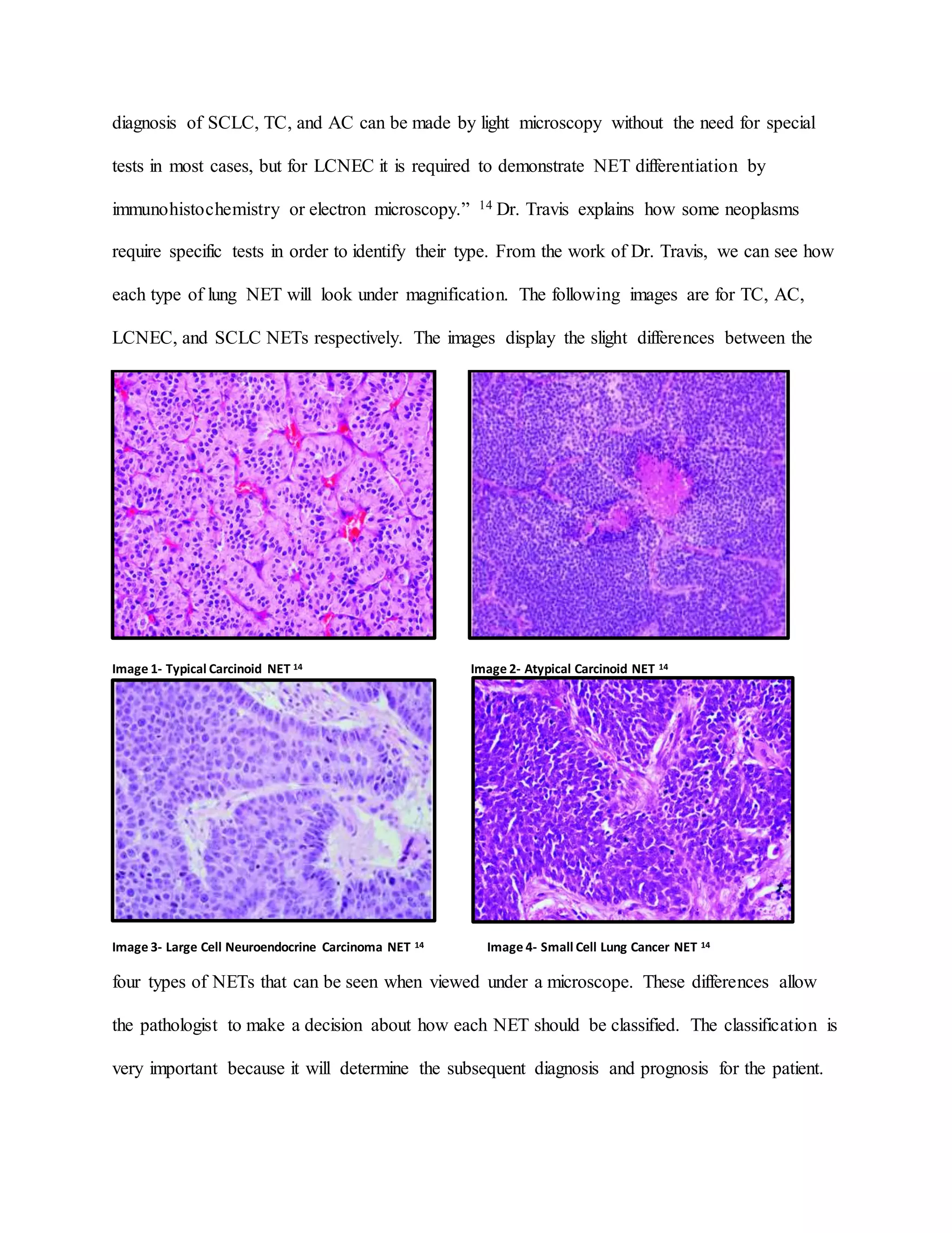 Pulmonary Neuroendocrine Tumors | DOCX
