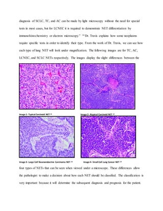 Pulmonary Neuroendocrine Tumors | DOCX
