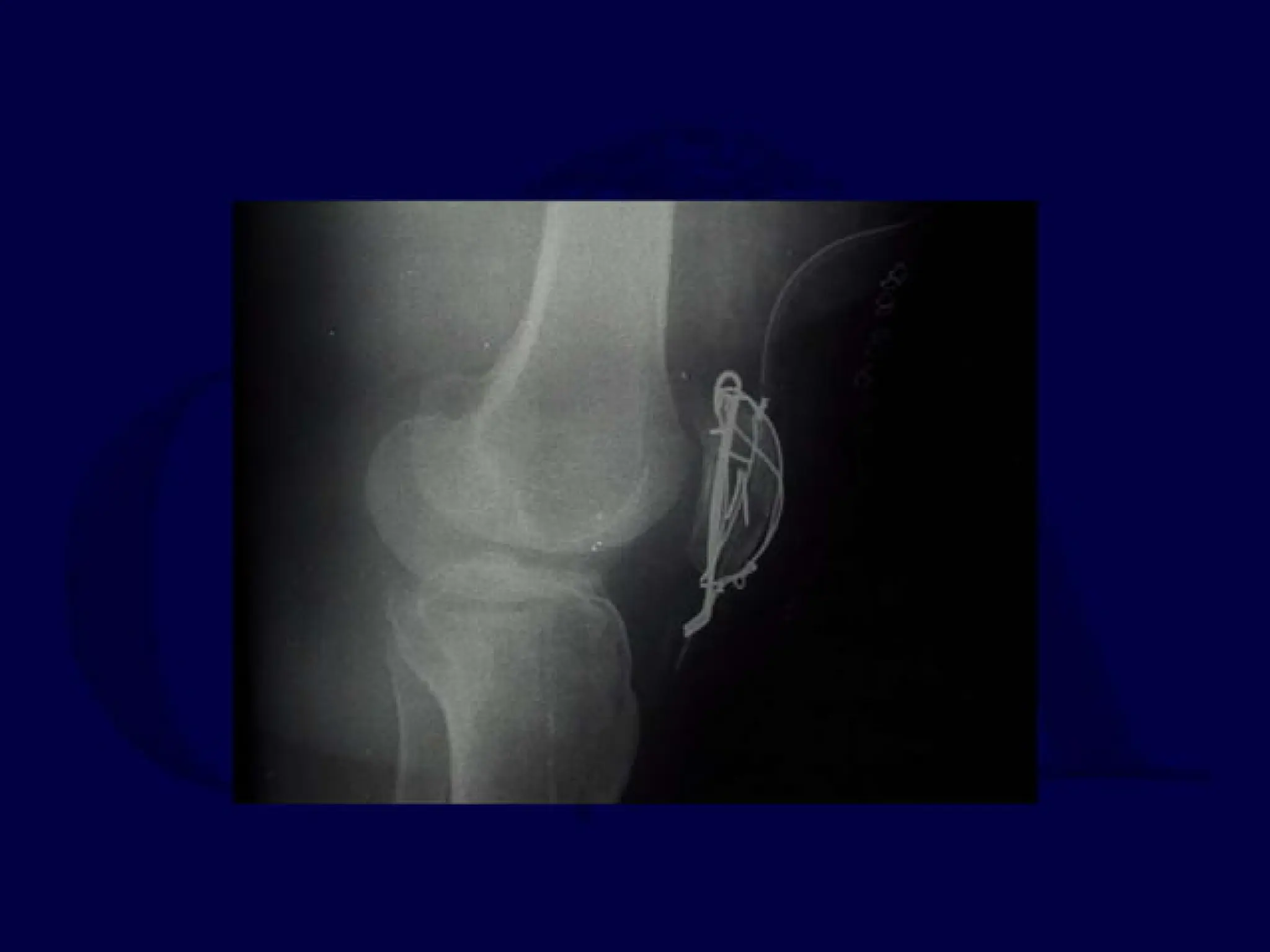 Patella fracture and extensor mechanism in injuries | PDF