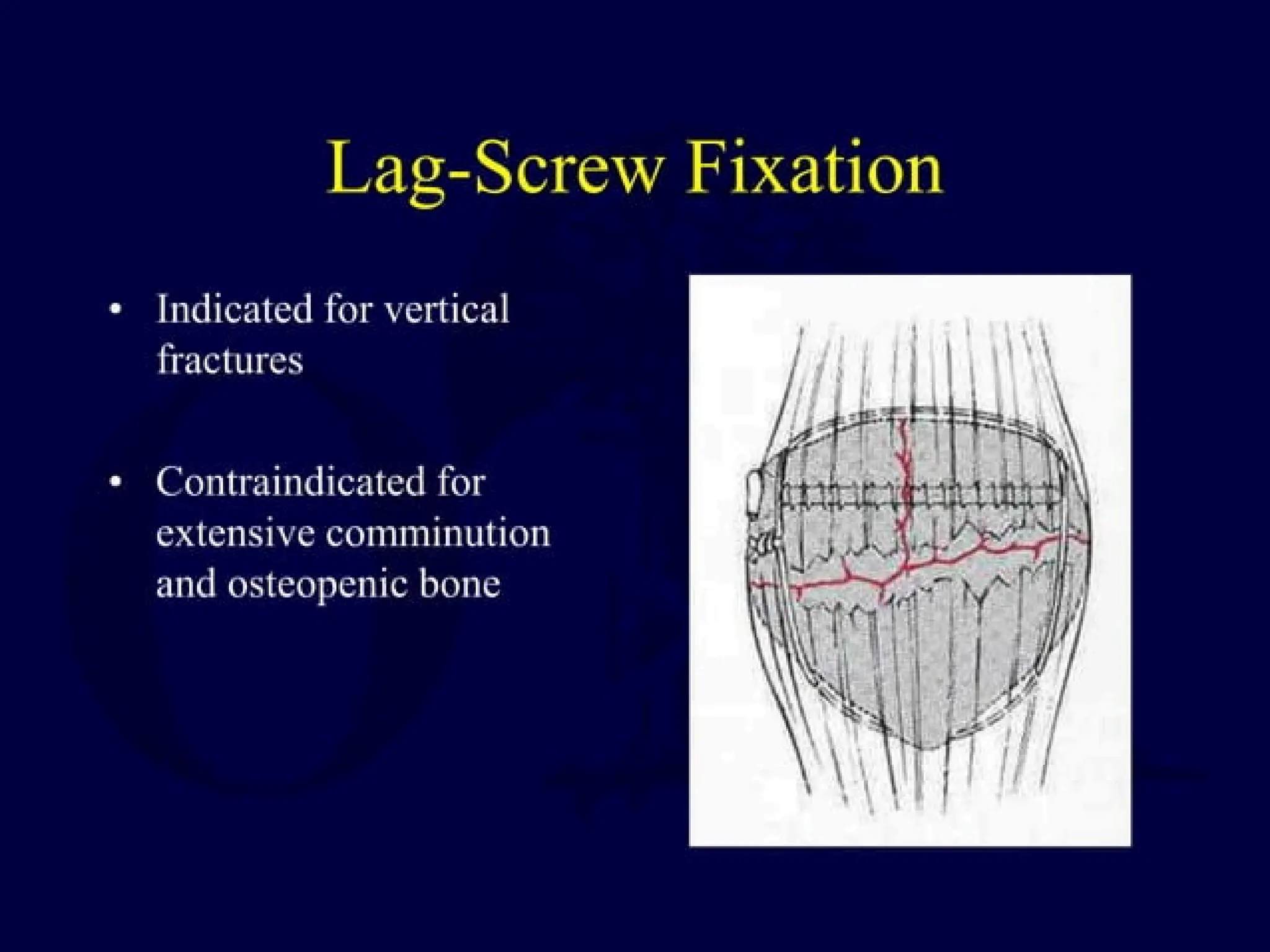 Patella fracture and extensor mechanism in injuries | PDF