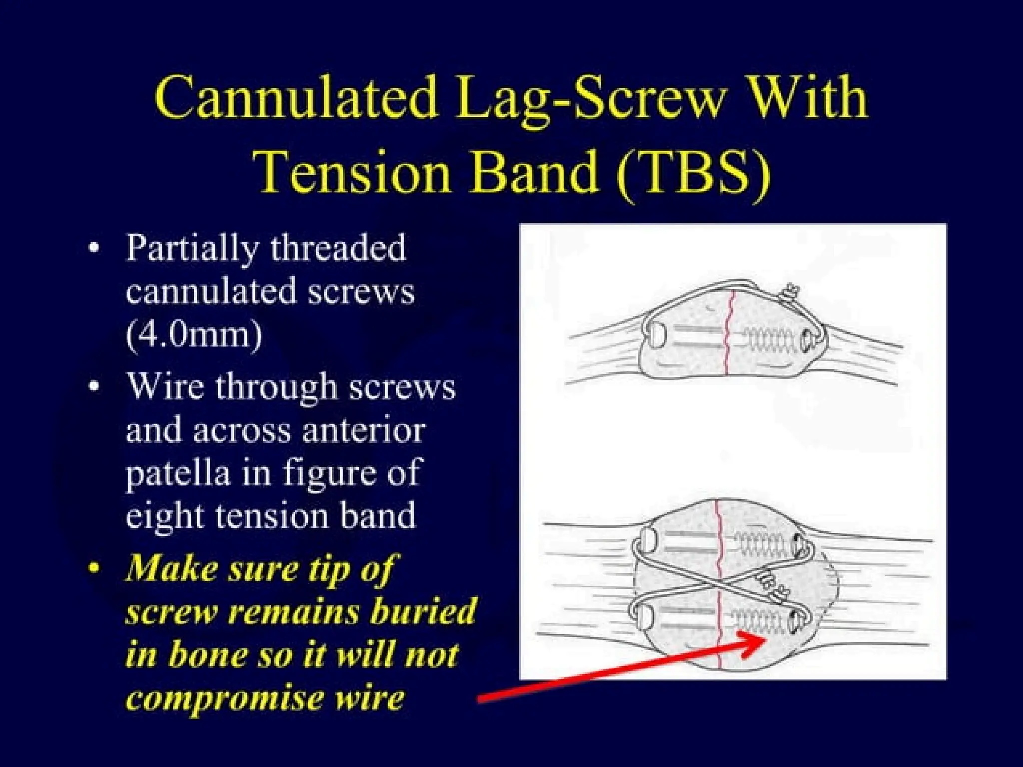 Patella fracture and extensor mechanism in injuries | PDF
