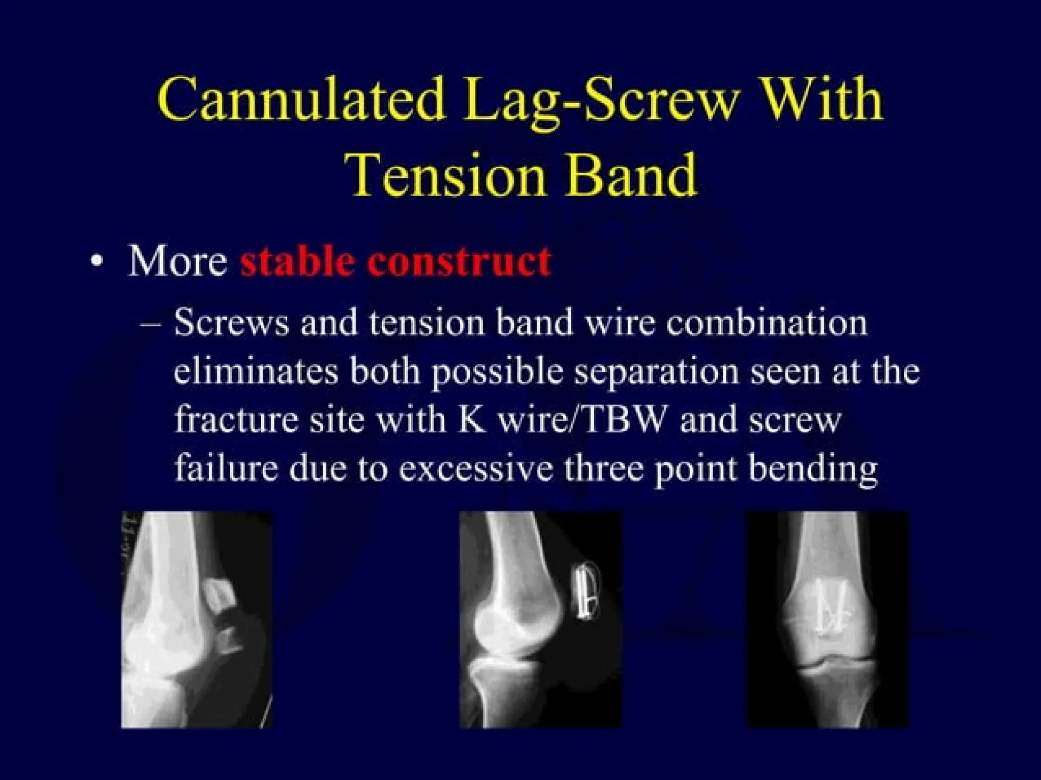 Patella fracture and extensor mechanism in injuries | PDF