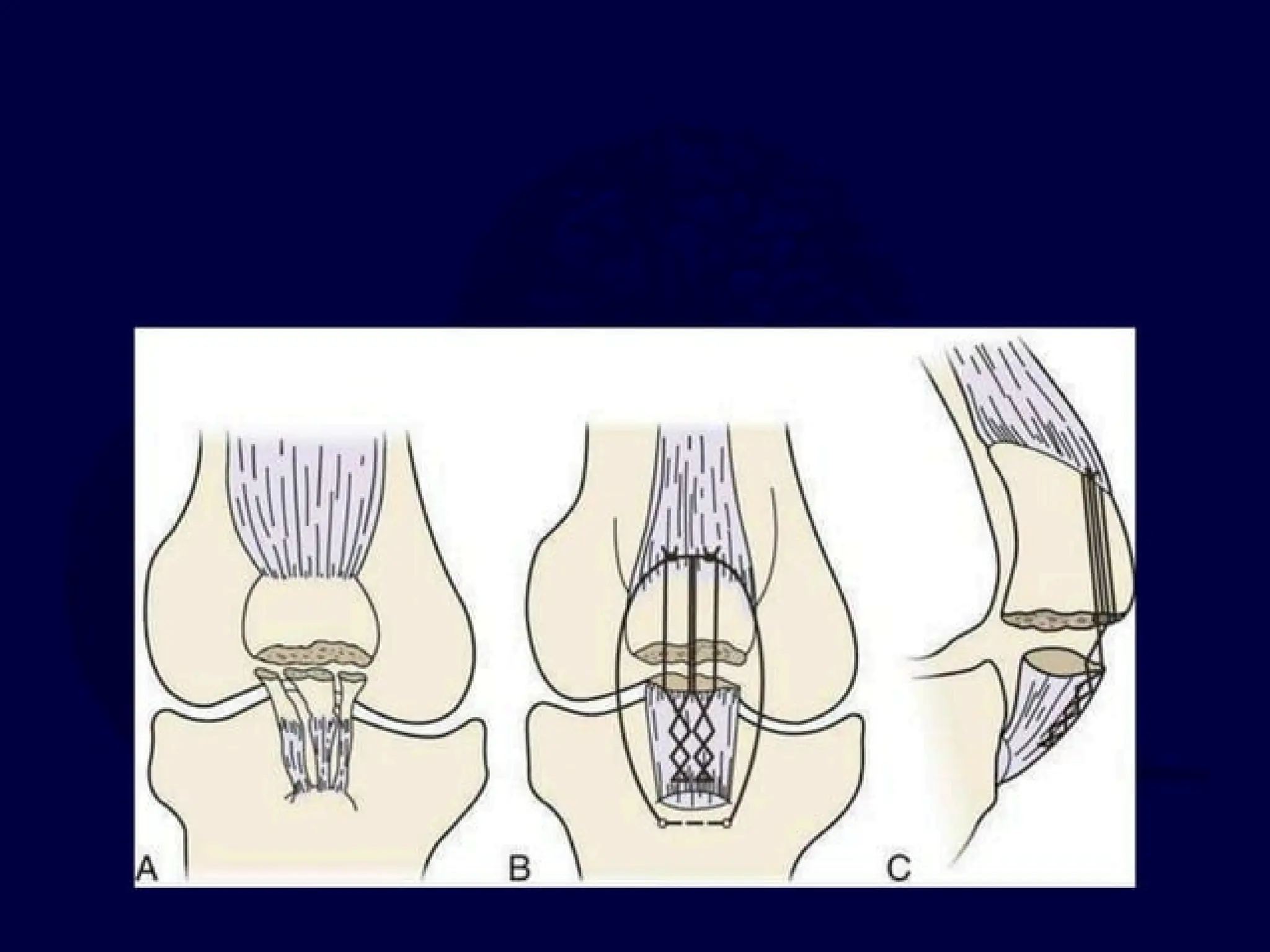 Patella fracture and extensor mechanism in injuries | PDF