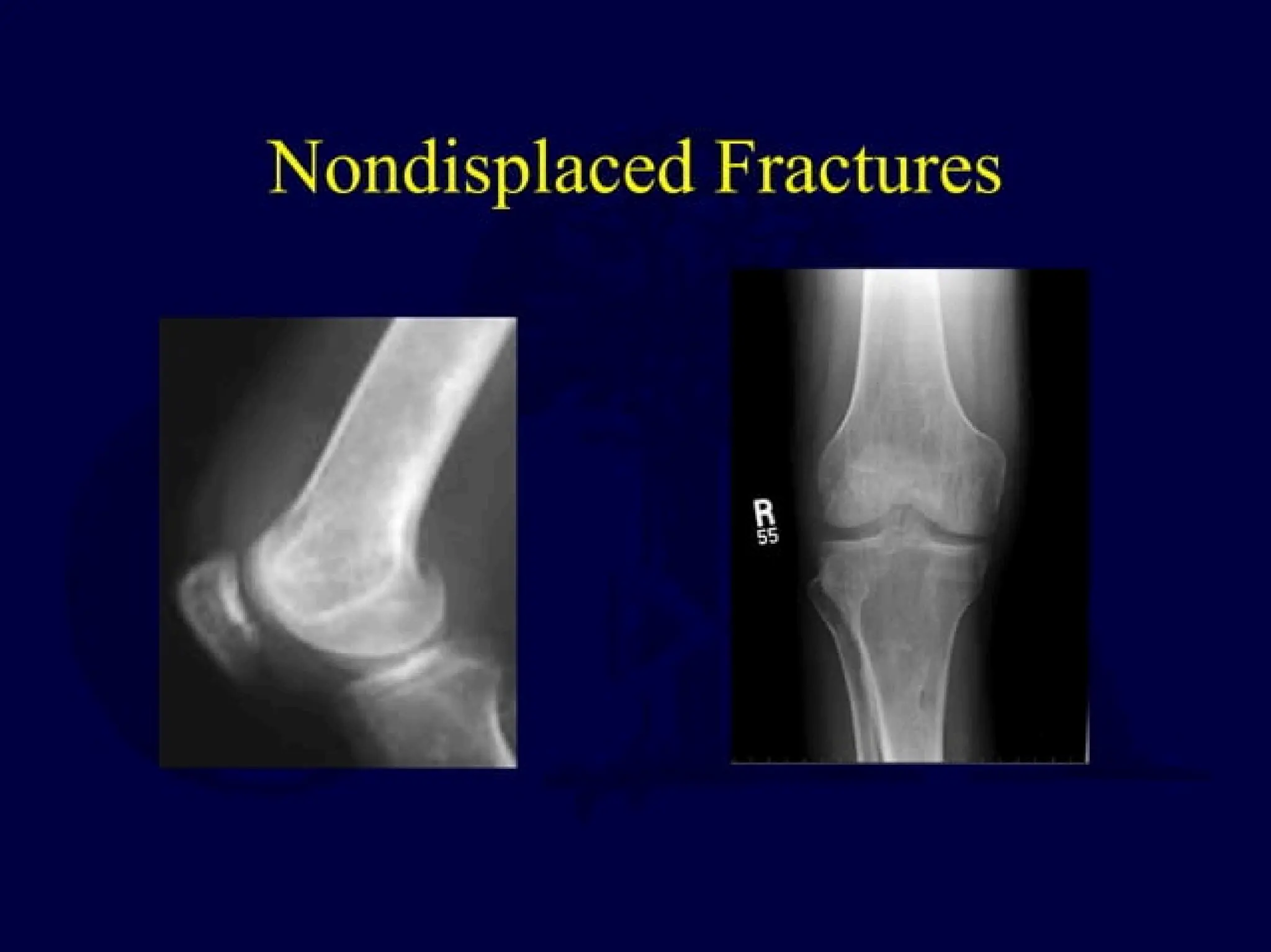 Patella fracture and extensor mechanism in injuries | PDF