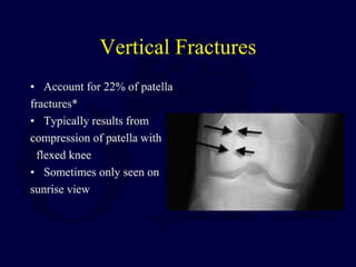 Patella fracture and extensor mechanism in injuries | PDF