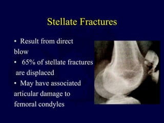 Patella fracture and extensor mechanism in injuries | PDF