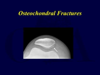 Patella fracture and extensor mechanism in injuries | PDF