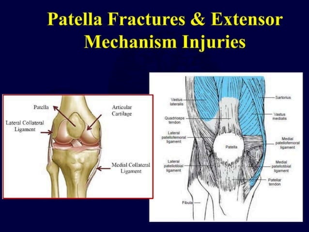 Patella fracture and extensor mechanism in injuries | PDF