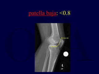 Patella fracture and extensor mechanism in injuries | PDF