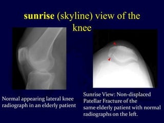 Patella fracture and extensor mechanism in injuries | PDF