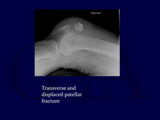 Patella fracture and extensor mechanism in injuries | PDF
