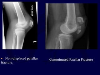 Patella fracture and extensor mechanism in injuries | PDF