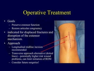 Patella fracture and extensor mechanism in injuries | PDF